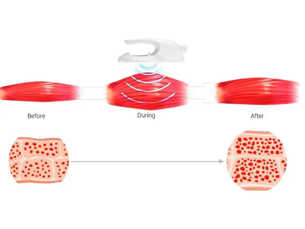 Effortless Transformation: Emsculpt Neo Benefits Unveiled - konmison ...
