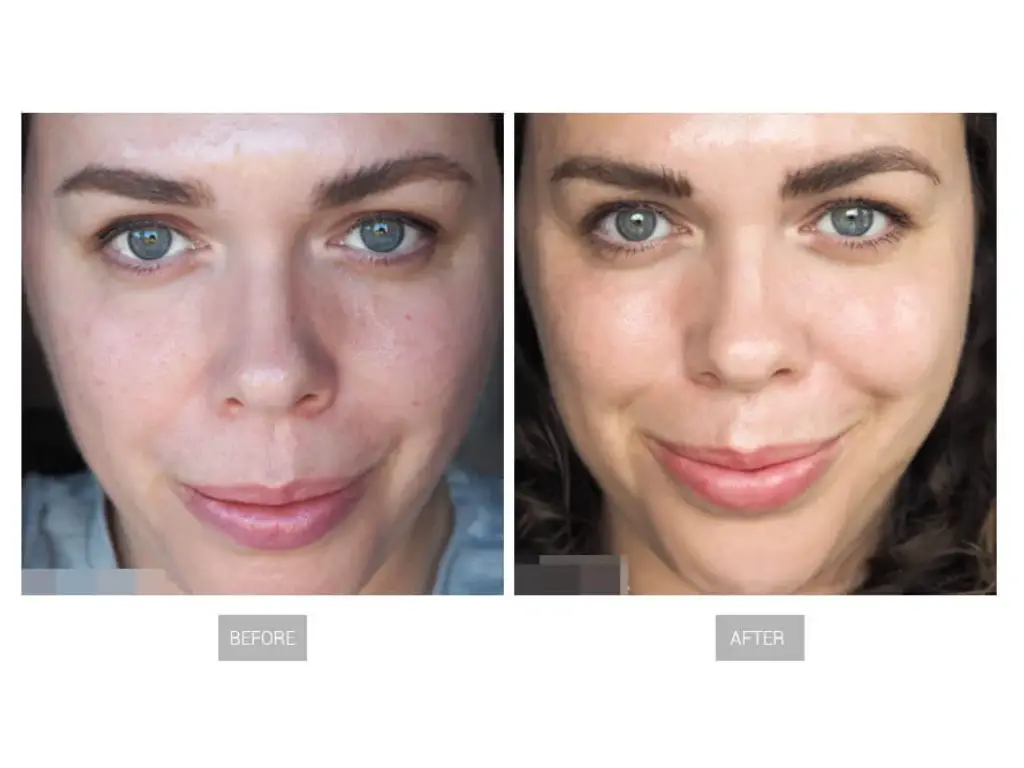 HydraFacial Pros und Cons: Kennen Sie die Risiken und Vorteile - Konmison