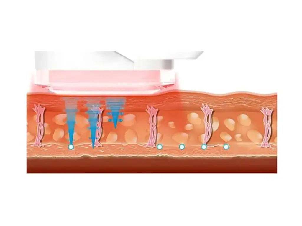 Understanding HIFU vs Ultherapy: Key Distinctions - konmison HIFU vs ...